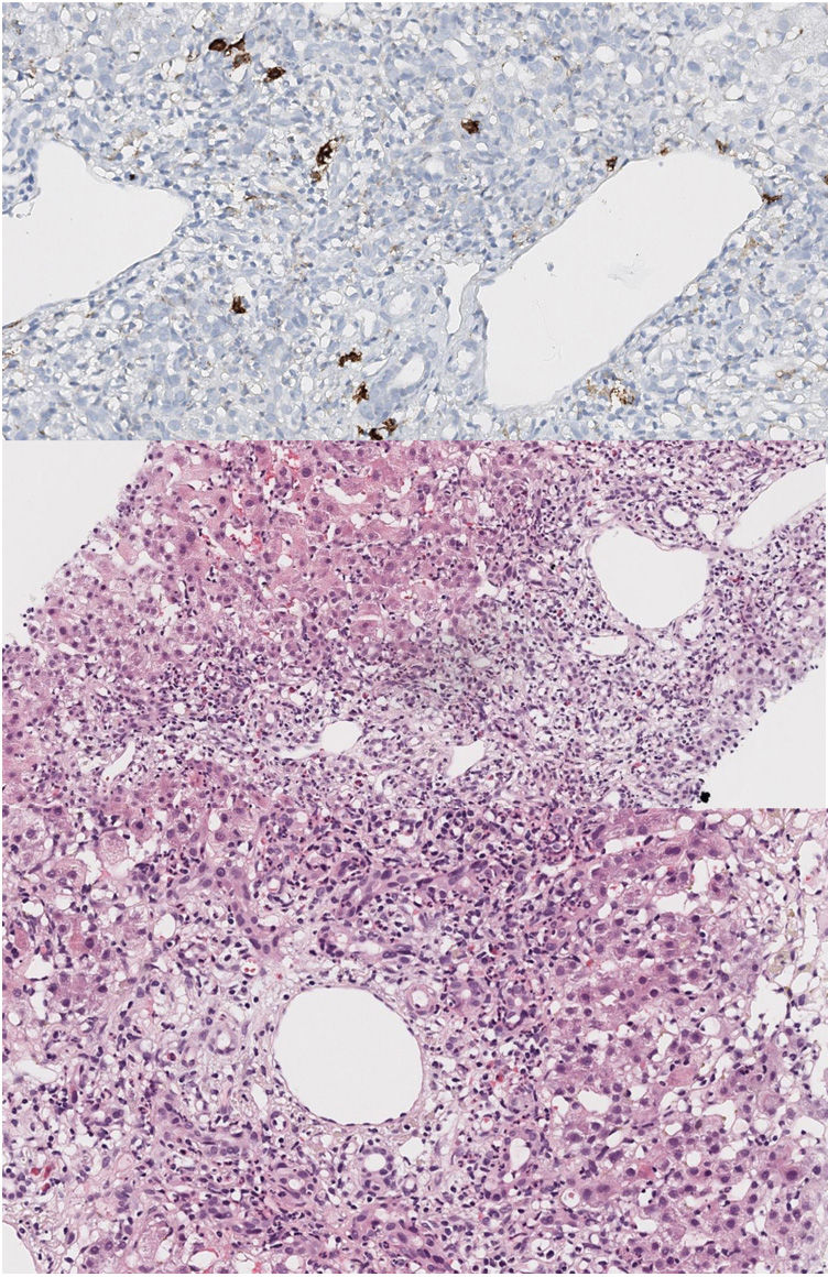 Drug induced autoimmune hepatitis after turmeric intake ...