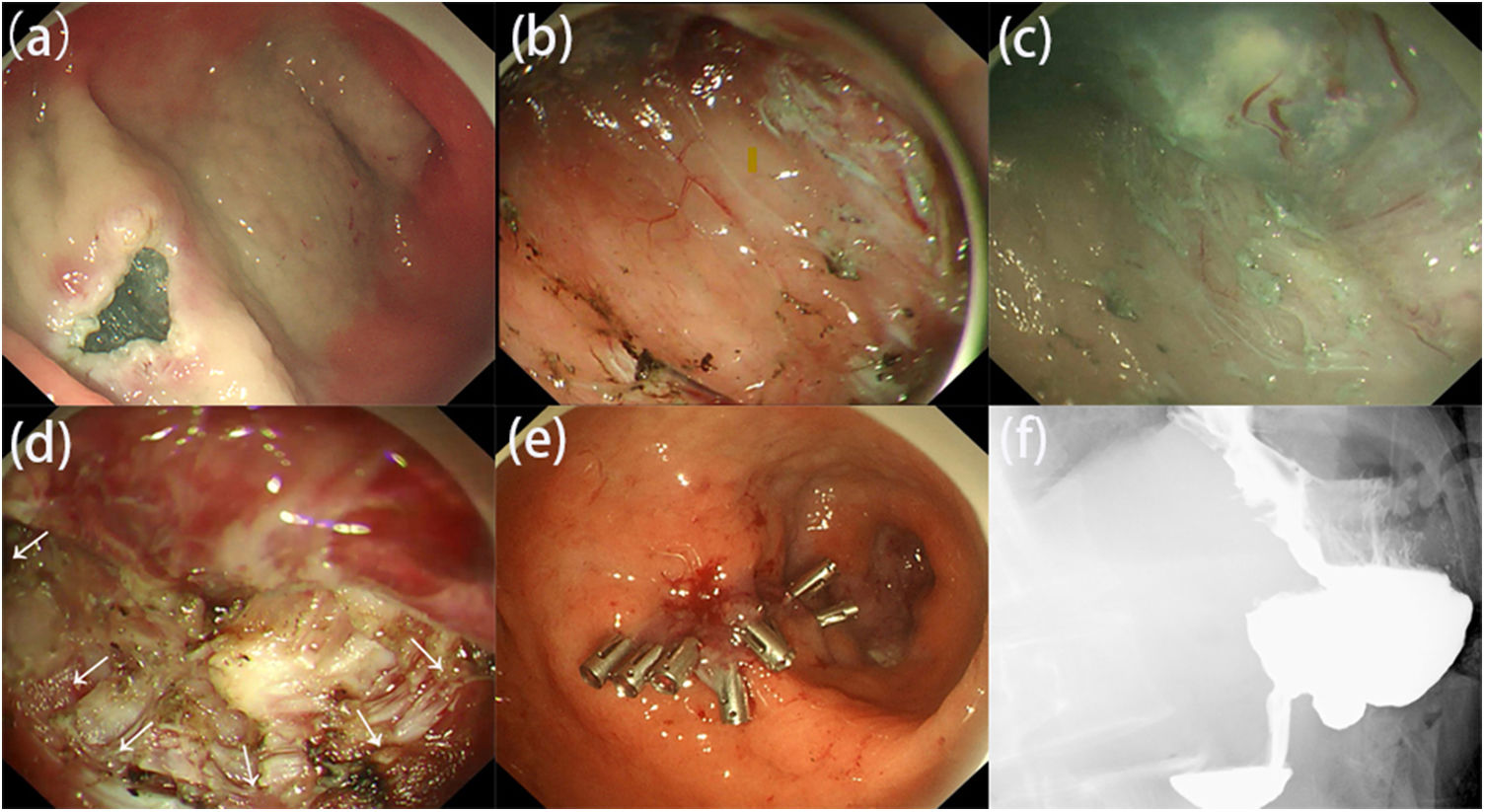 open pyloromyotomy