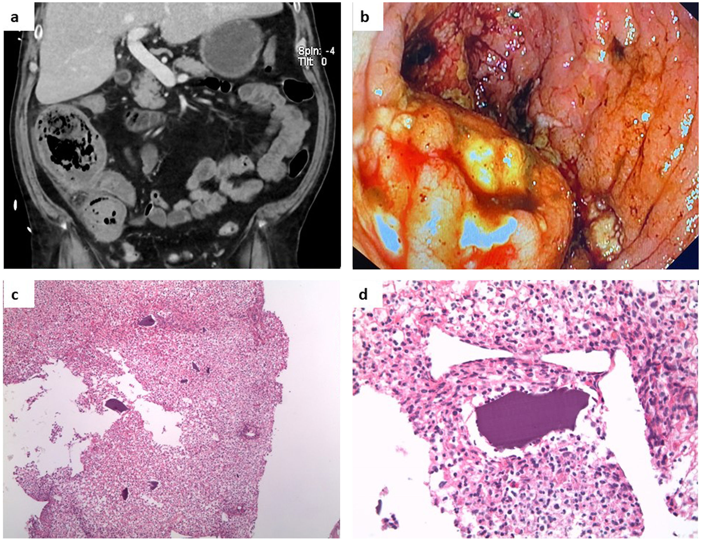Ischemic colitis due to Kayexalate crystals | Gastroenterología y ...