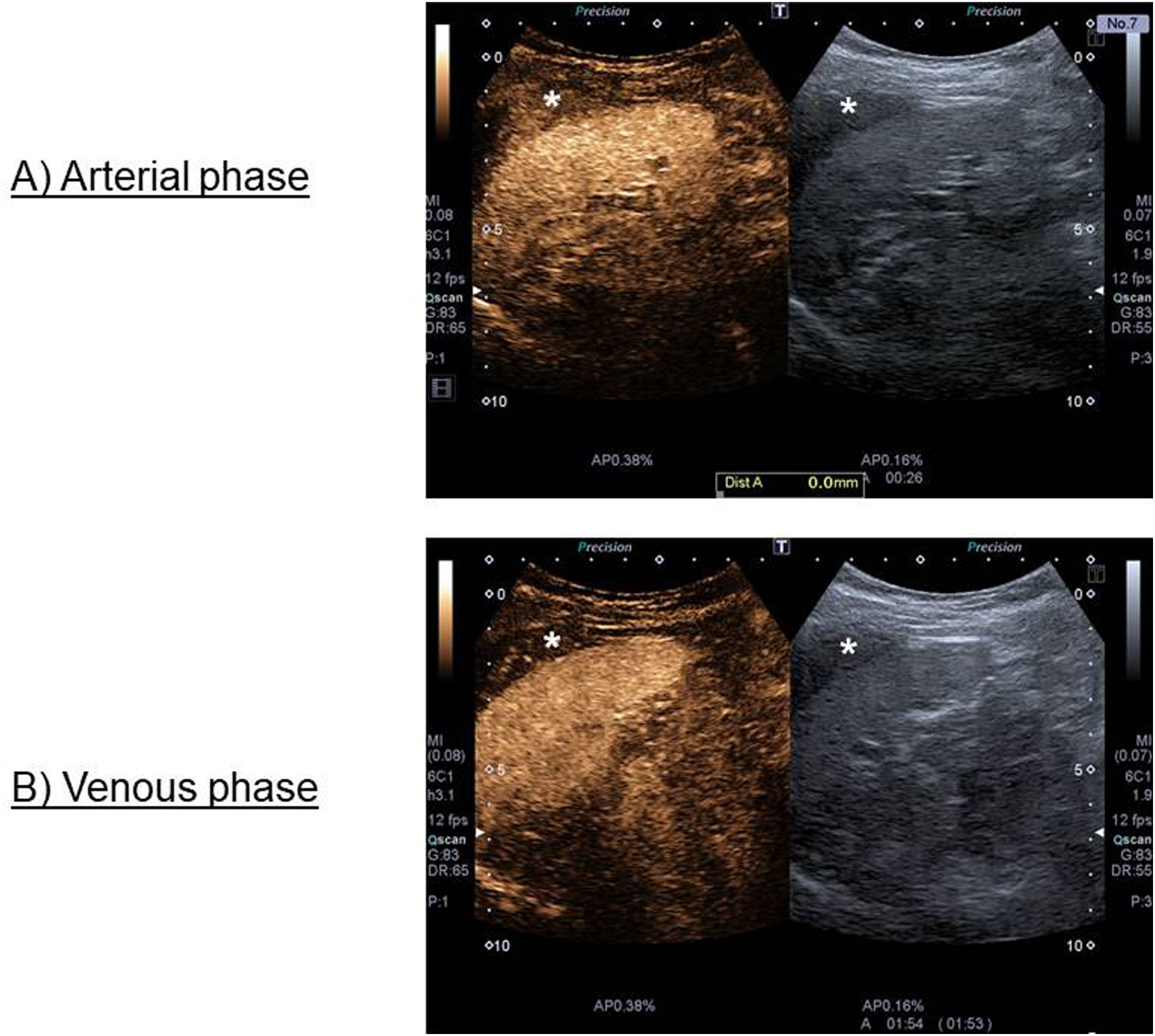Beaver tail liver | Gastroenterología y Hepatología (English Edition)