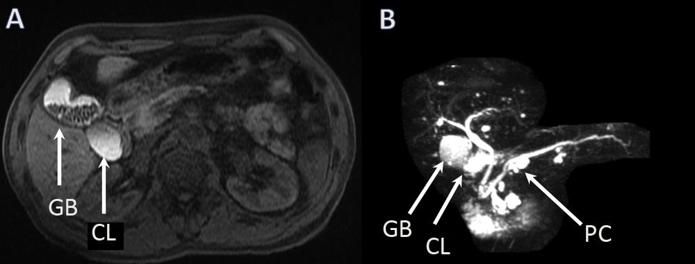 Septated gallbladder | Gastroenterología y Hepatología (English Edition)