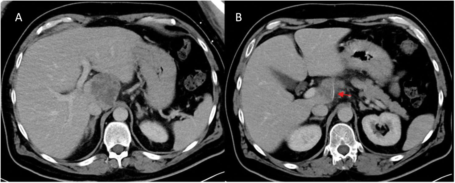 Hepatic abscess secondary to gastrohepatic migration of a fishbone ...