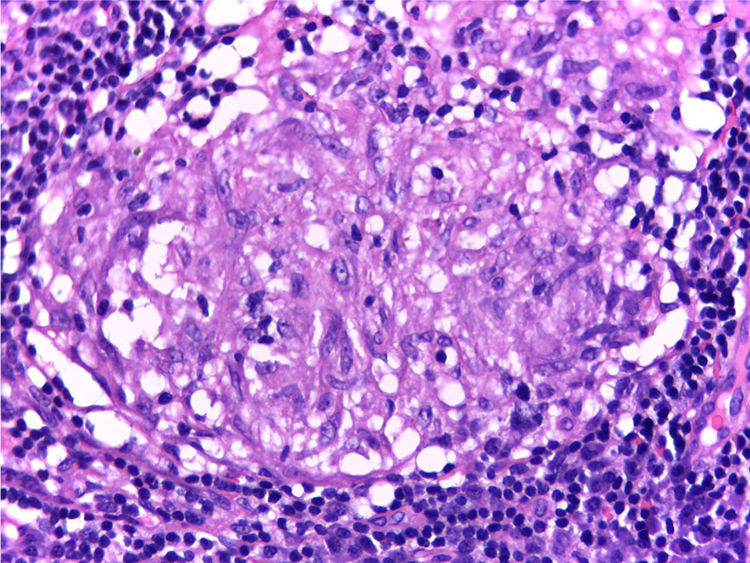 Löfgren syndrome as an acute presentation of sarcoidoisis | Revista ...