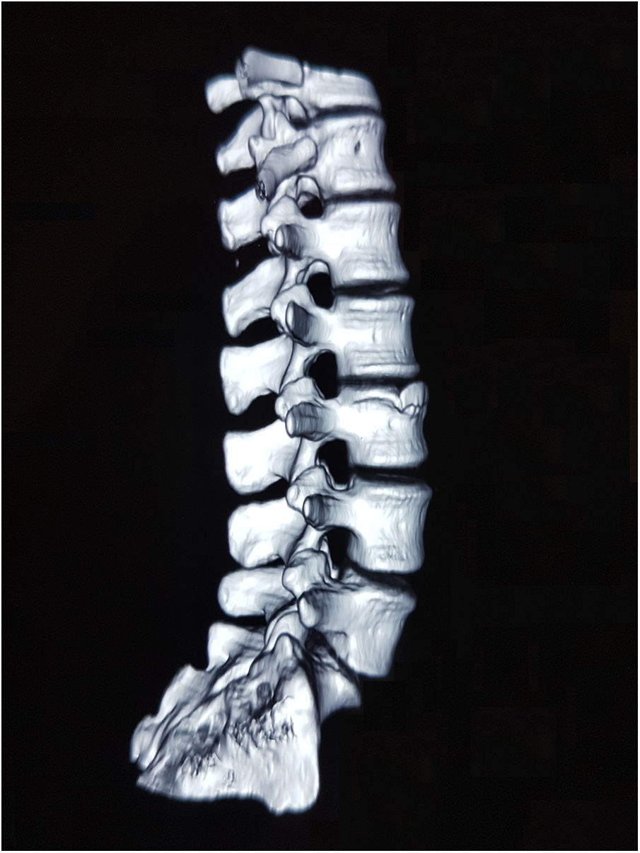 limbus vertebra cause