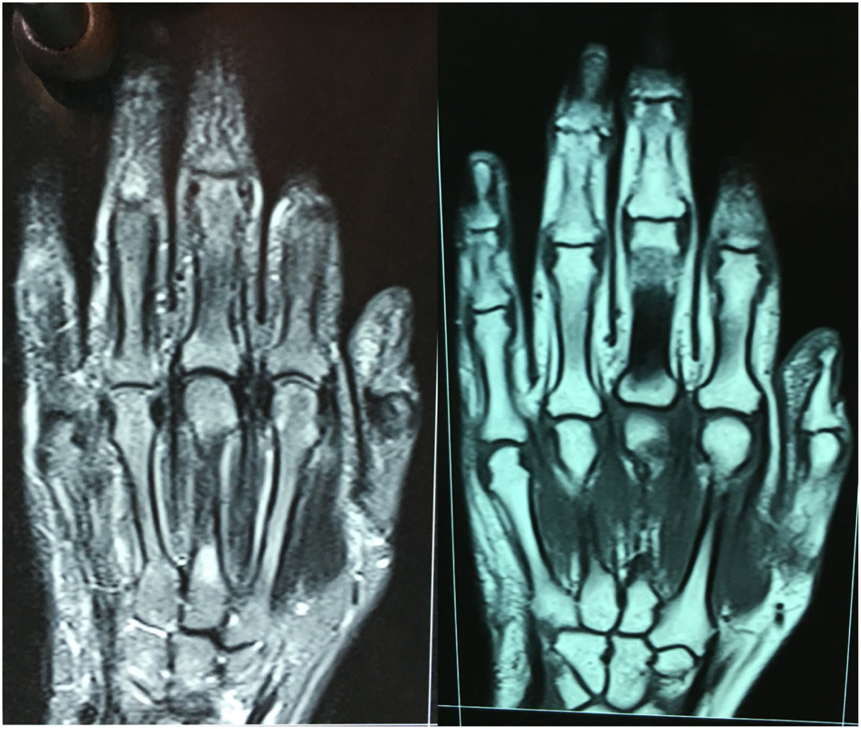 Point of care ultrasound for the diagnosis of polymyalgia rheumatica in ...