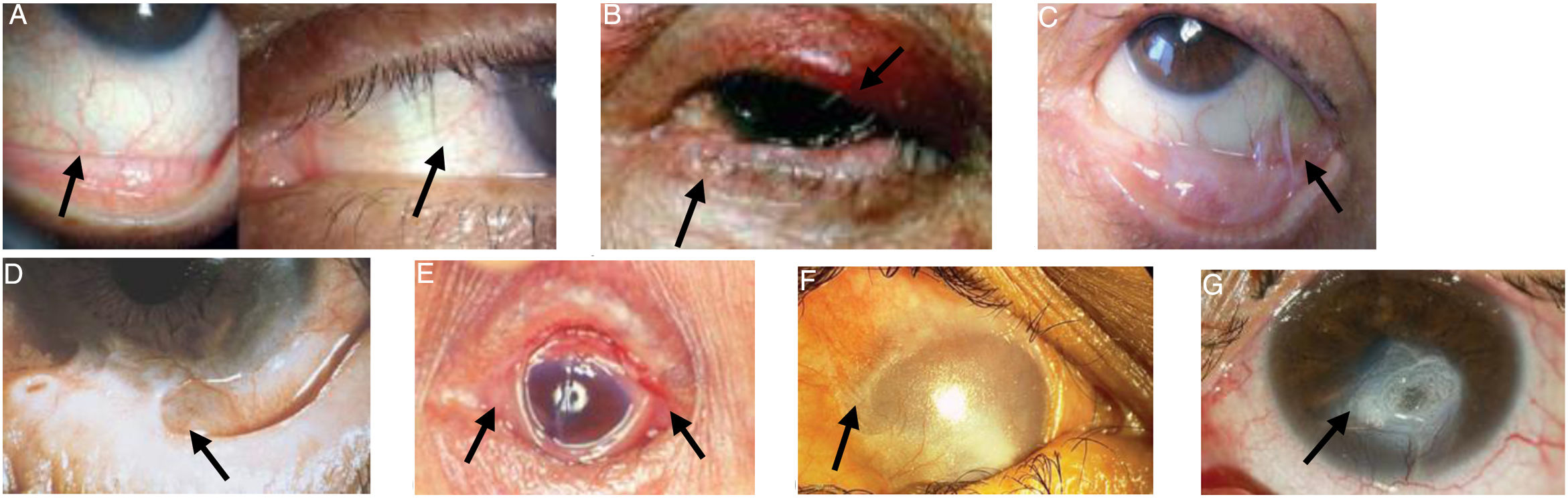 pemphigoid eye