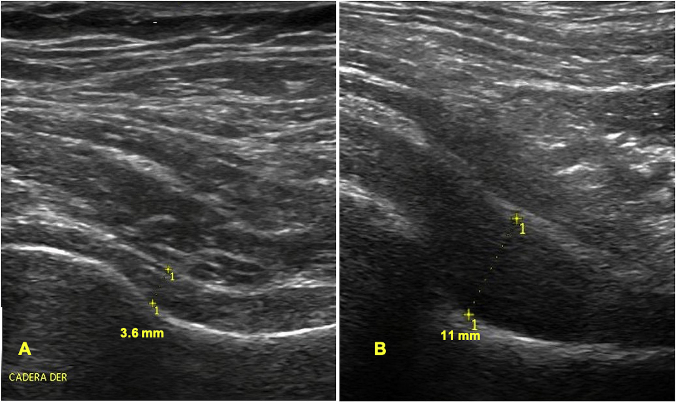 Subclinical hip involvement in rheumatoid arthritis. An ultrasound ...