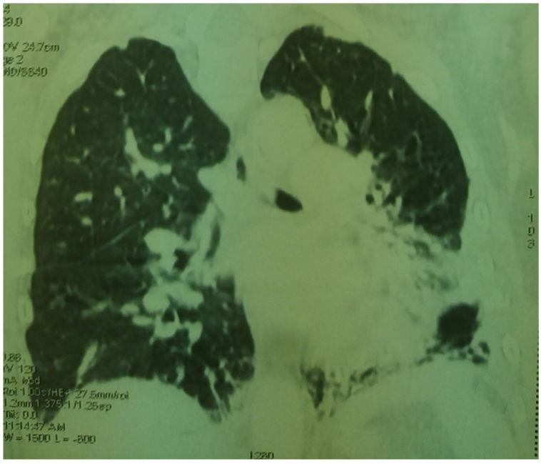 Shrinking lung syndrome. A rare pulmonary manifestation of lupus: A ...