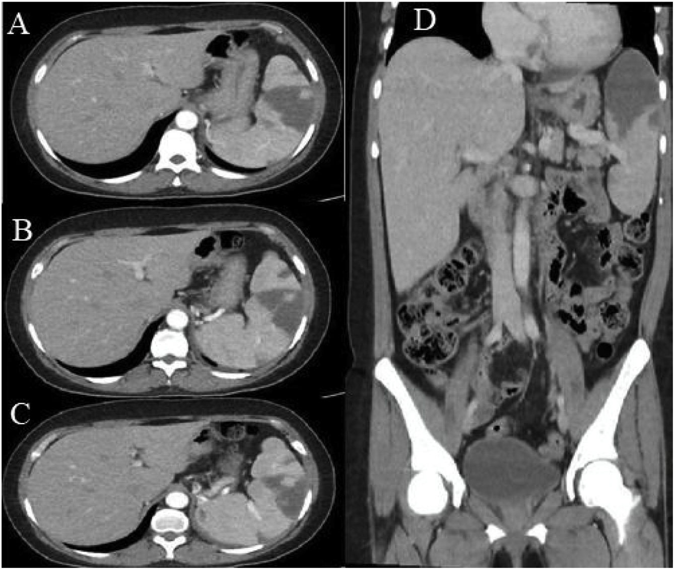 Splenic infarction as presentation of antiphospholipid syndrome and ...