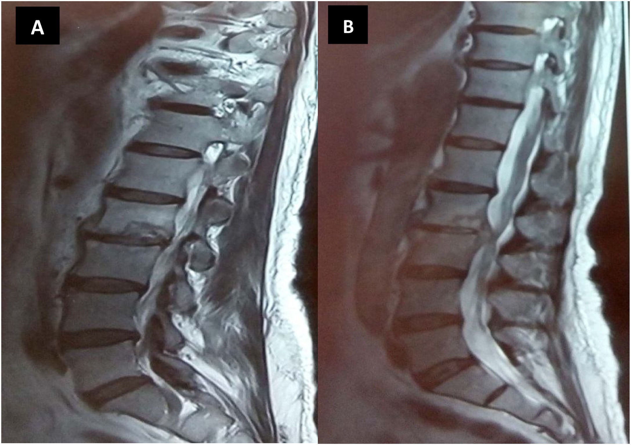 Infectious spondylodiscitis: When a rare infection is associated with ...