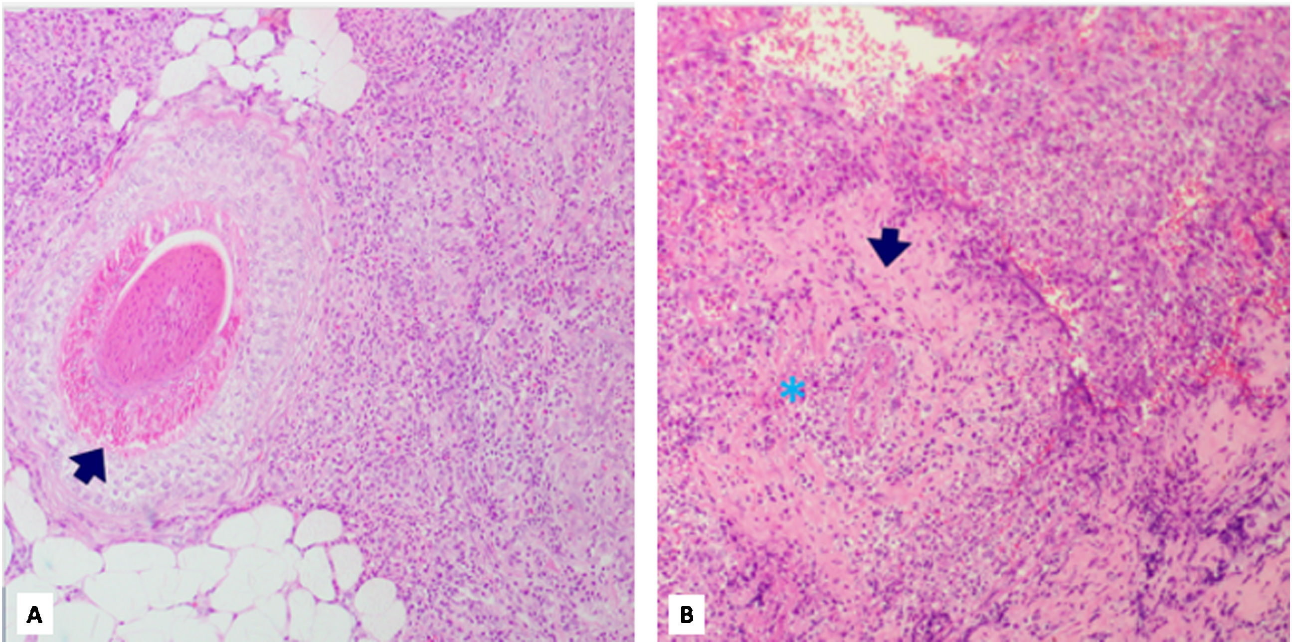 Granulomatosis with polyangiitis and skin ulcers mimicking pyoderma ...