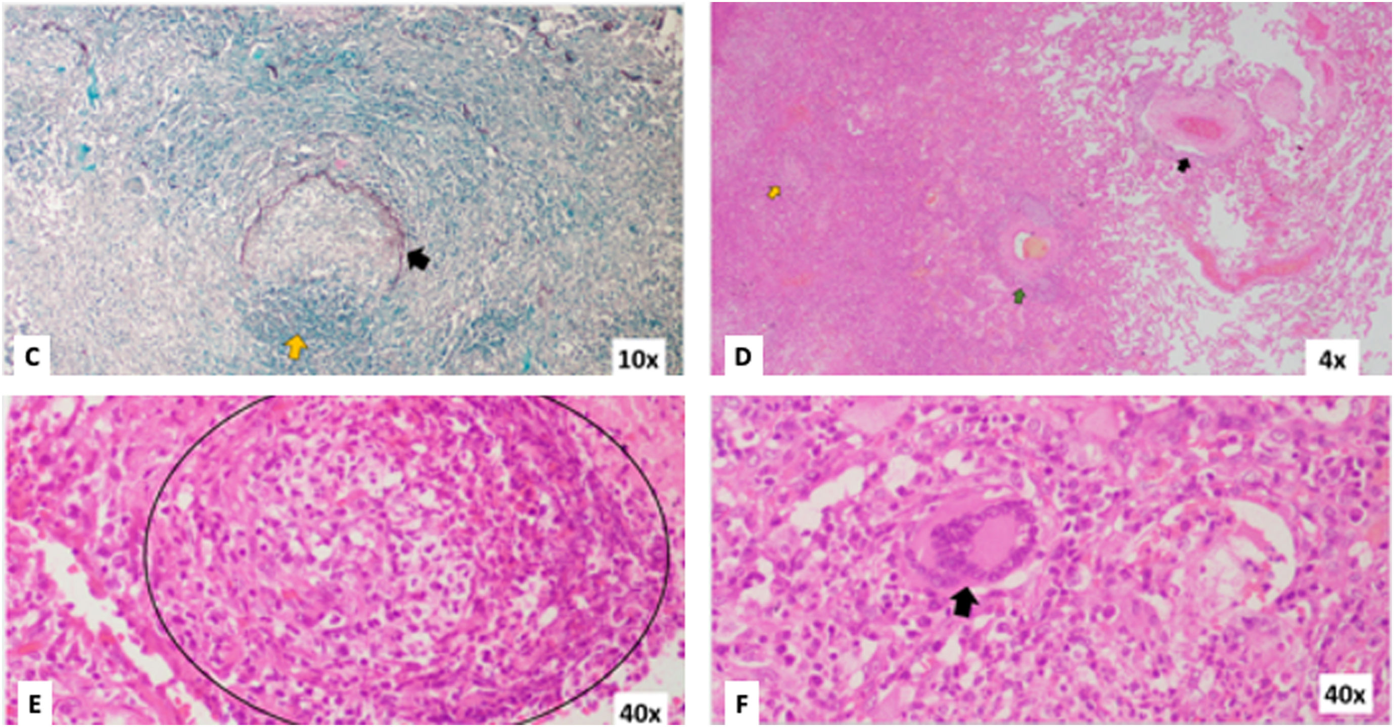 Granulomatosis with polyangiitis and skin ulcers mimicking pyoderma ...