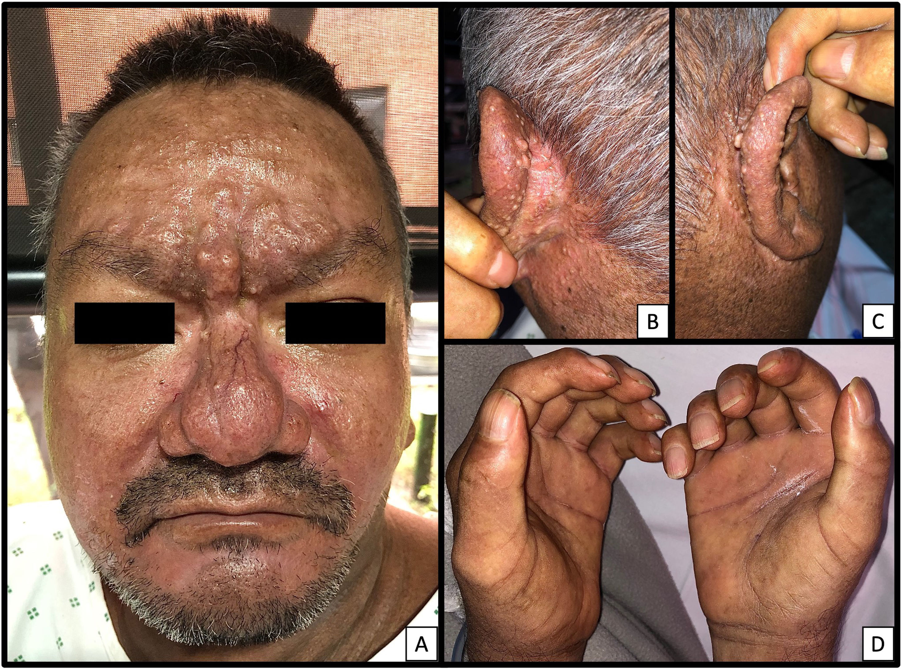 scleromyxedema pictures