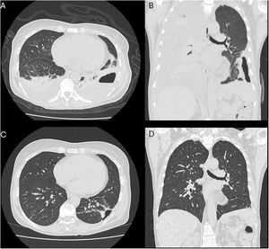 ANCA-associated vasculitis with severe pulmonary involvement as an ...