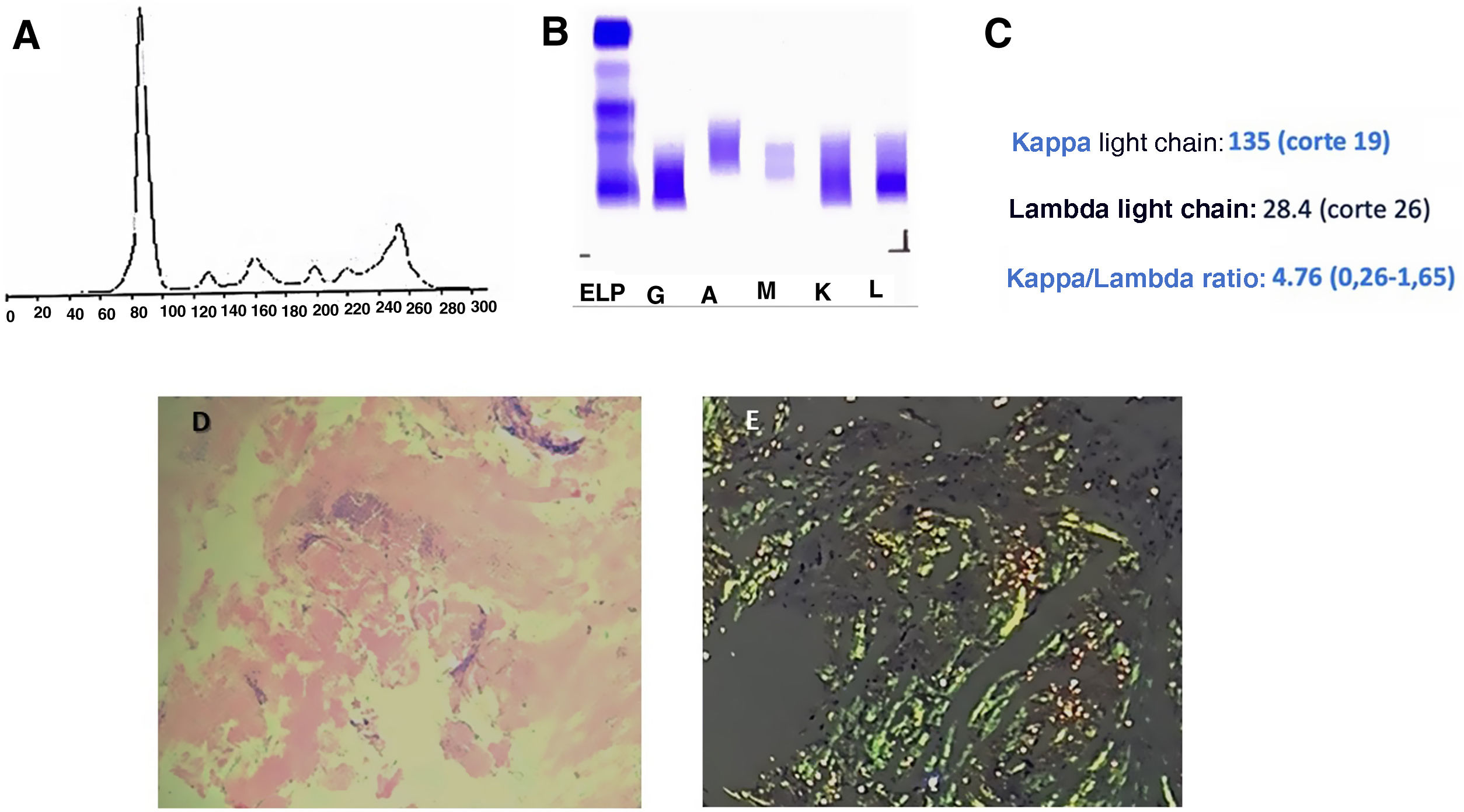 Haematological complication with pulmonary impact in a patient with ...