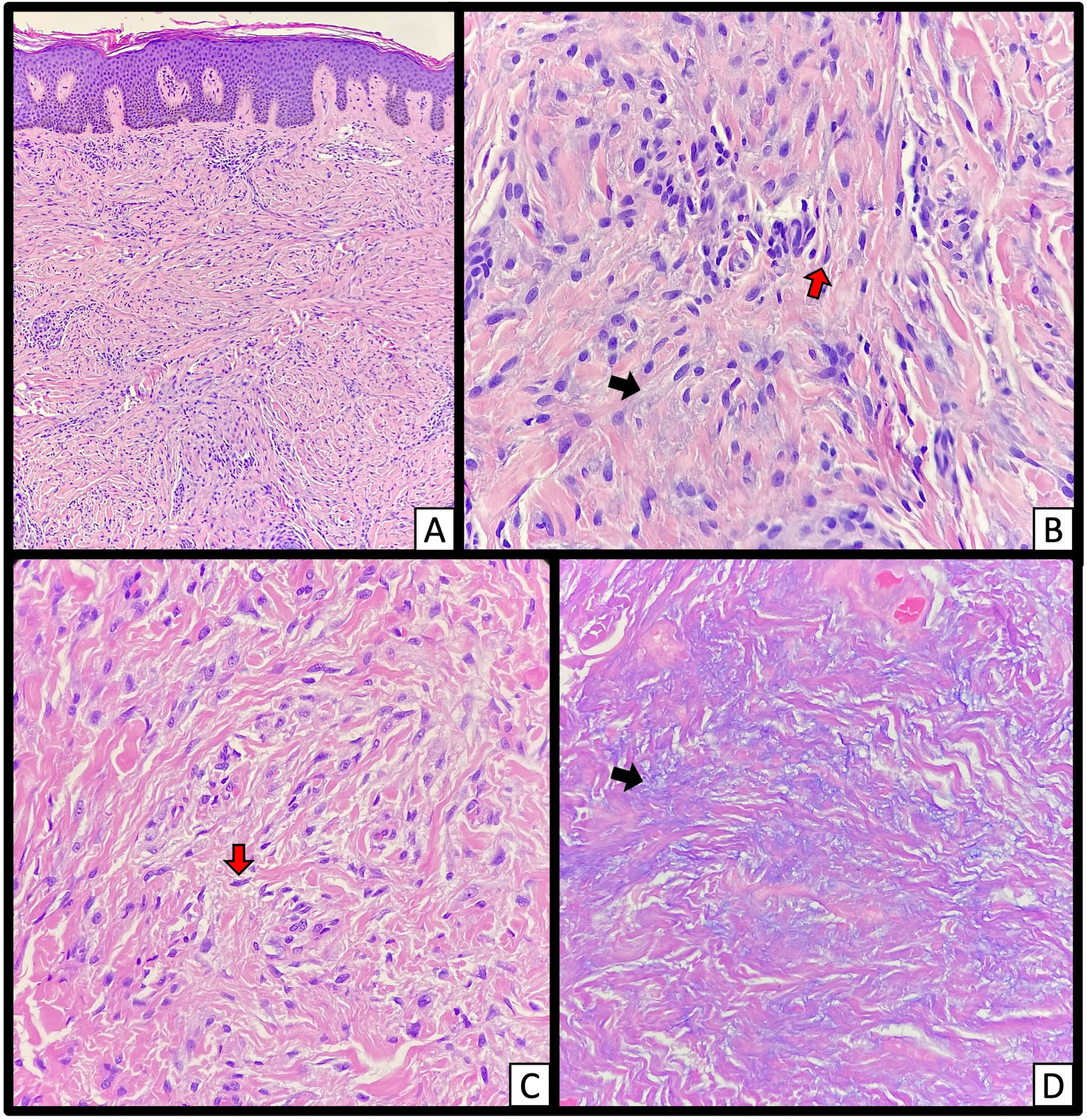 Scleromyxoedema with extracutaneous pulmonary manifestation: A case ...