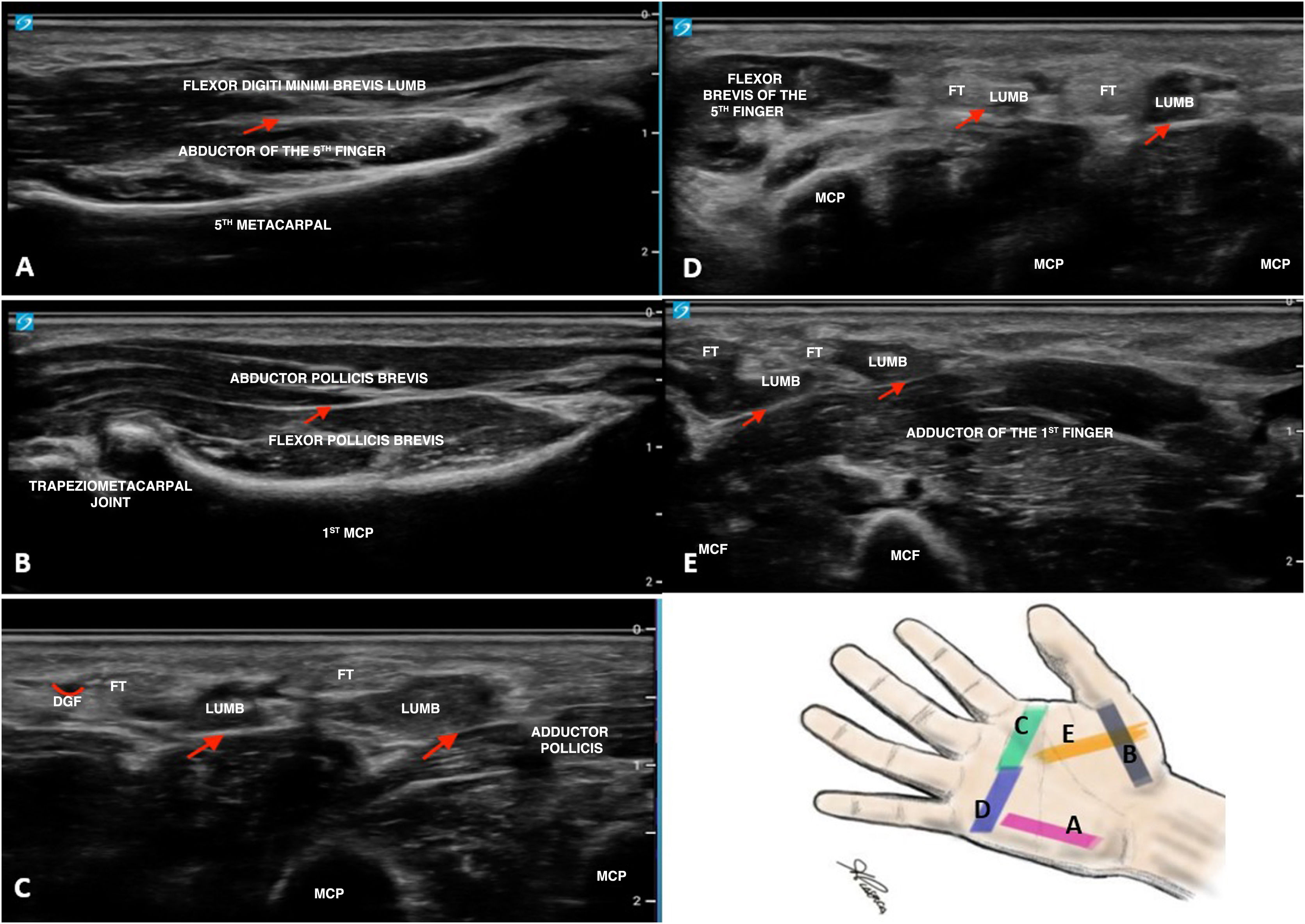 Retrospective study on the effectiveness of ultrasound-guided ...