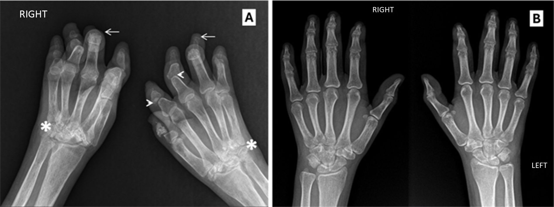 Arthritis mutilans, not always psoriatic disease. Case report | Revista ...