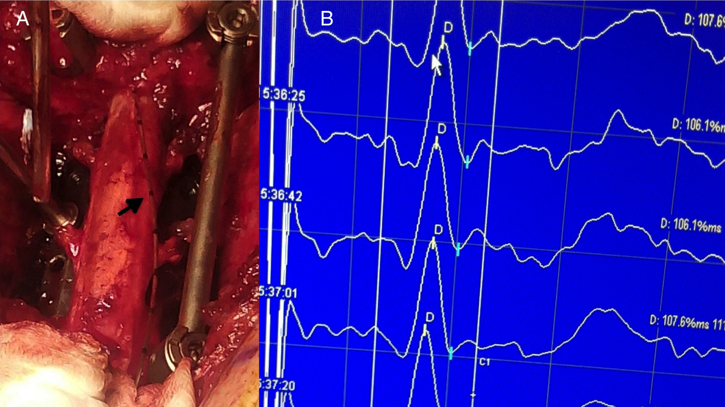 Total en bloc spondylectomy for spinal tumours: Technical aspects and ...