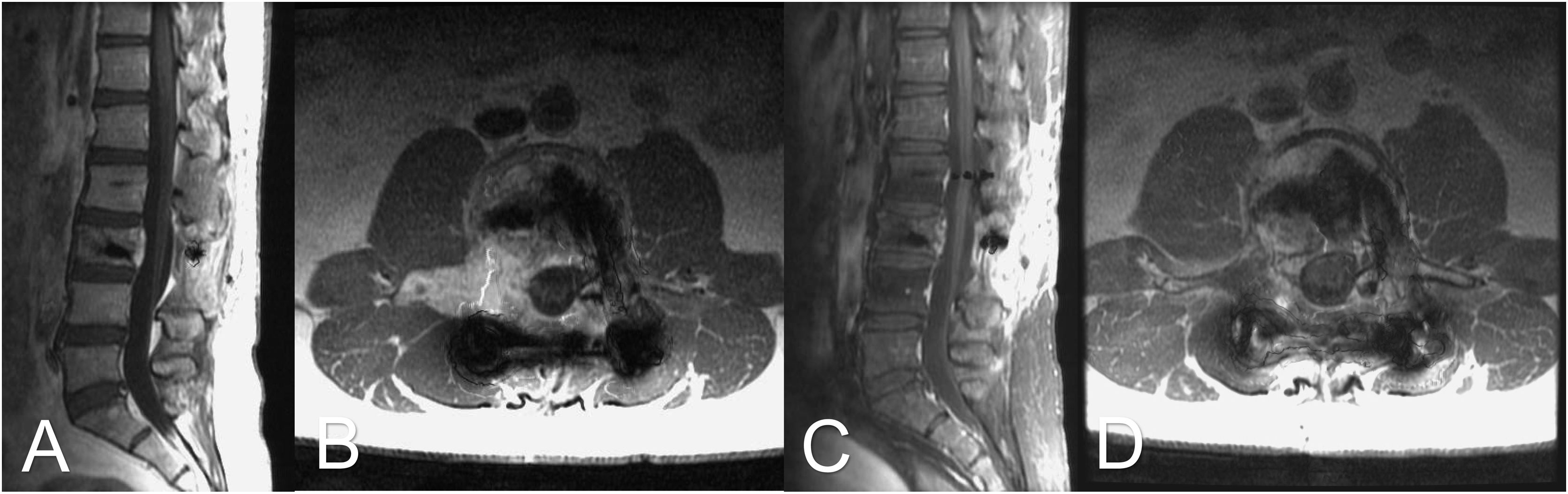 Primary epidural lumbar Ewing sarcoma presenting as cauda equina ...