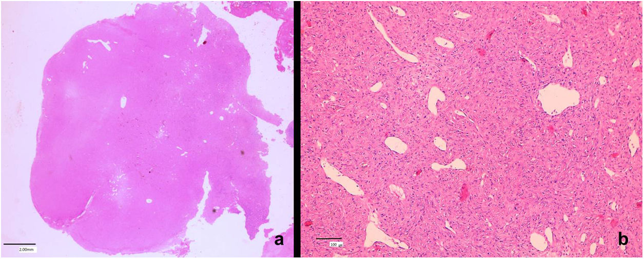 Recurrent meningeal malignant tumor: Assessment of differences in the ...