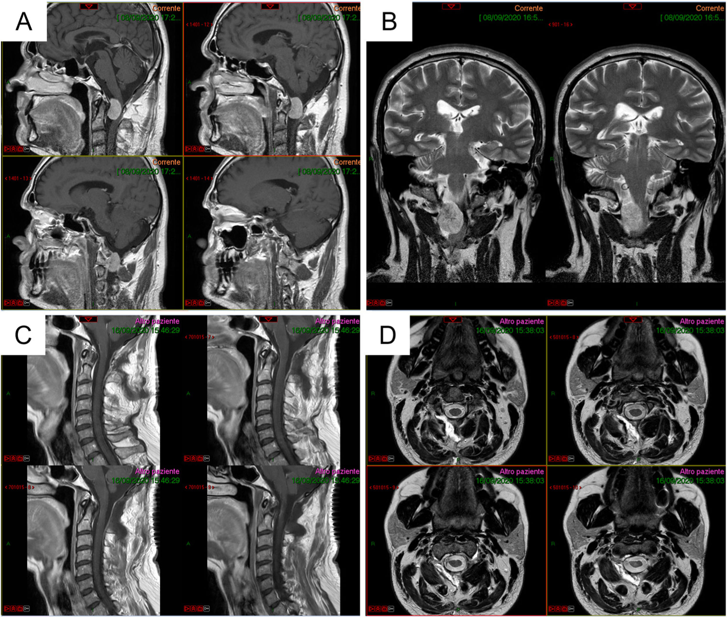 High definition 4K-three-dimensional exoscope for removal of a C1-C2 ...