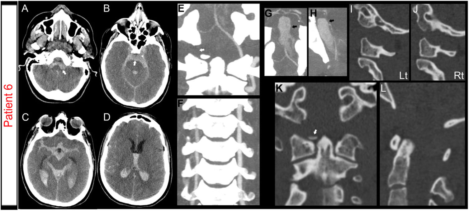 Atlanto-occipital dislocation with concomitant severe traumatic brain ...