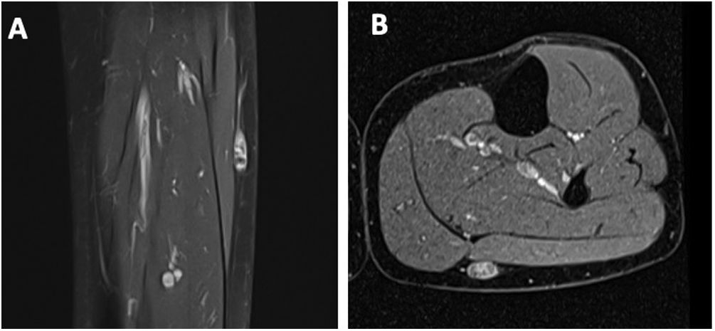 Cavernous hemangioma of the peripherical nerve: A case report ...