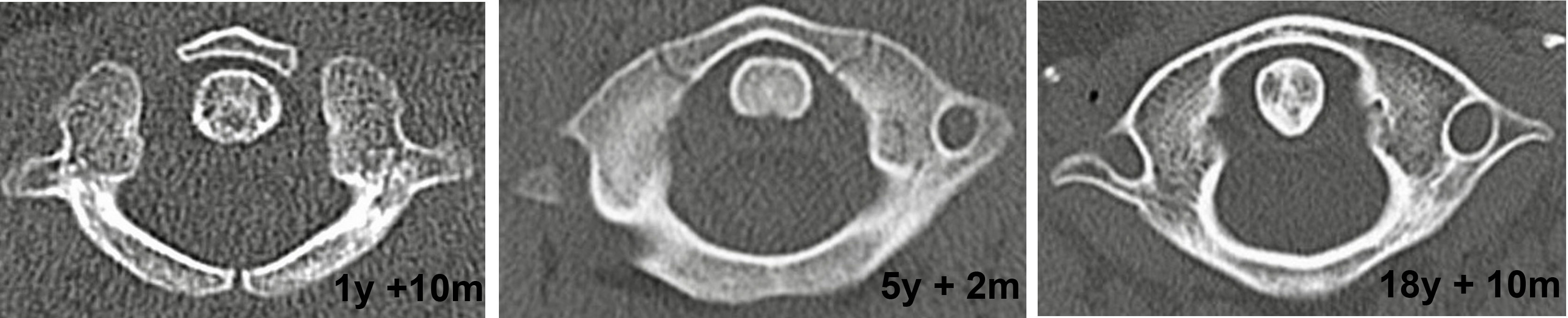 Pediatric atlas anatomy and its implications for fracture treatment: an ...