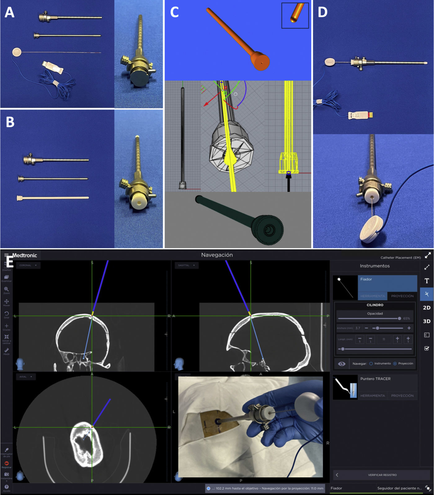 Electromagnetic neuronavigation in neuroendoscopy. Navigation proposal ...
