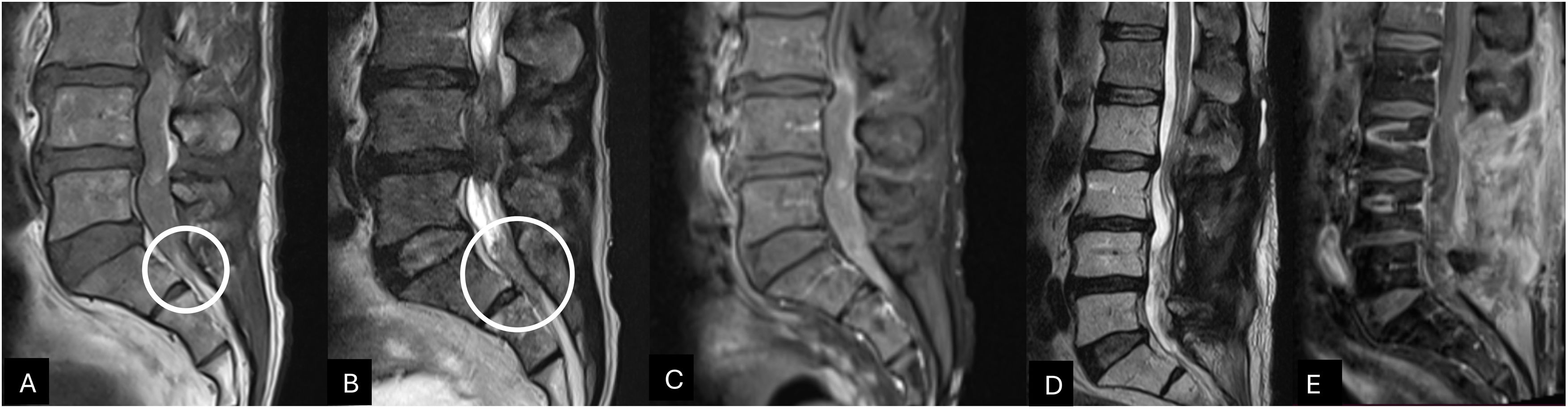 Cauda equina malignant peripheral nerve sheath tumor presenting with ...