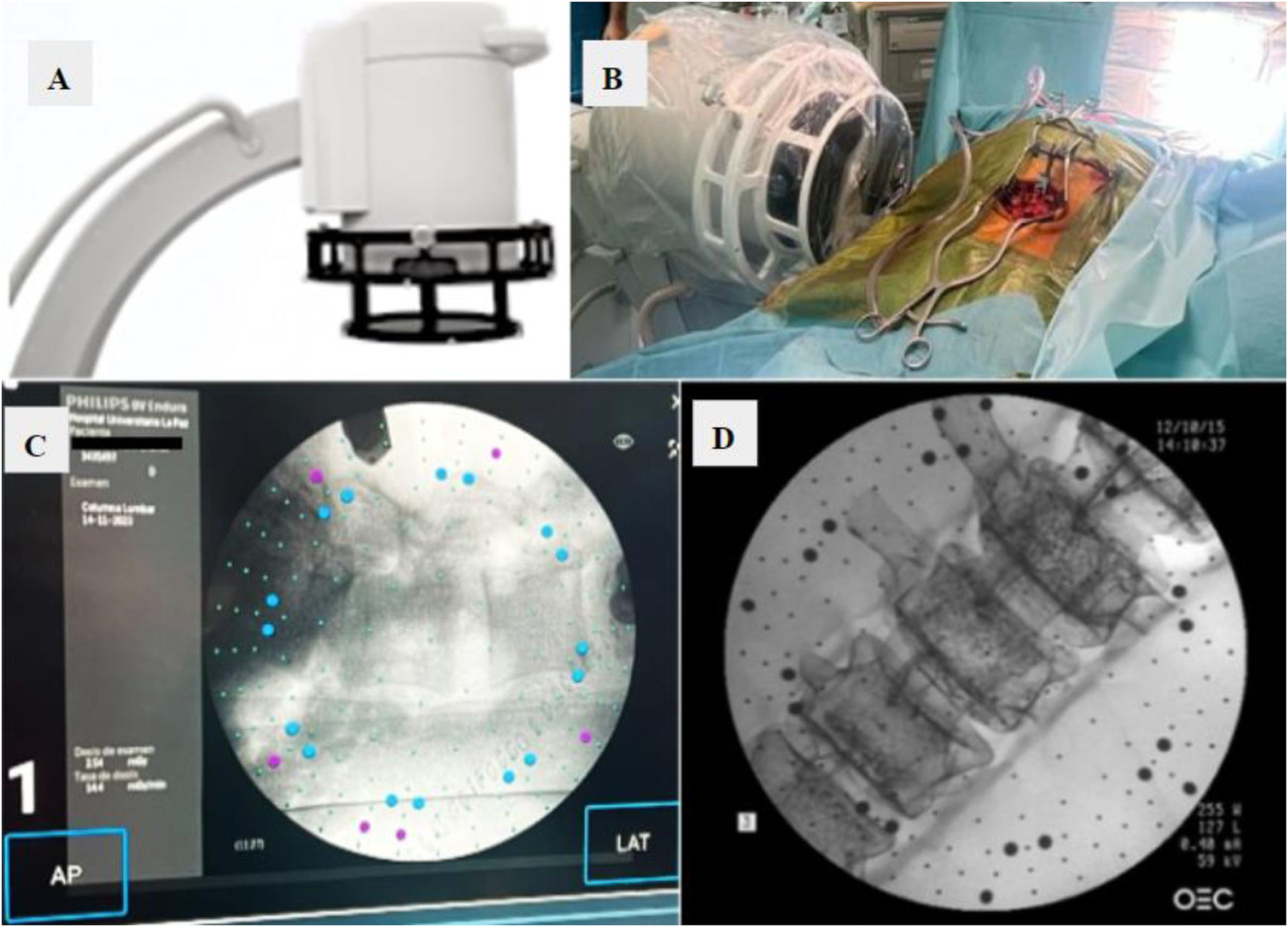 Robotic spine surgery: Technical note and descriptive analysis of the ...
