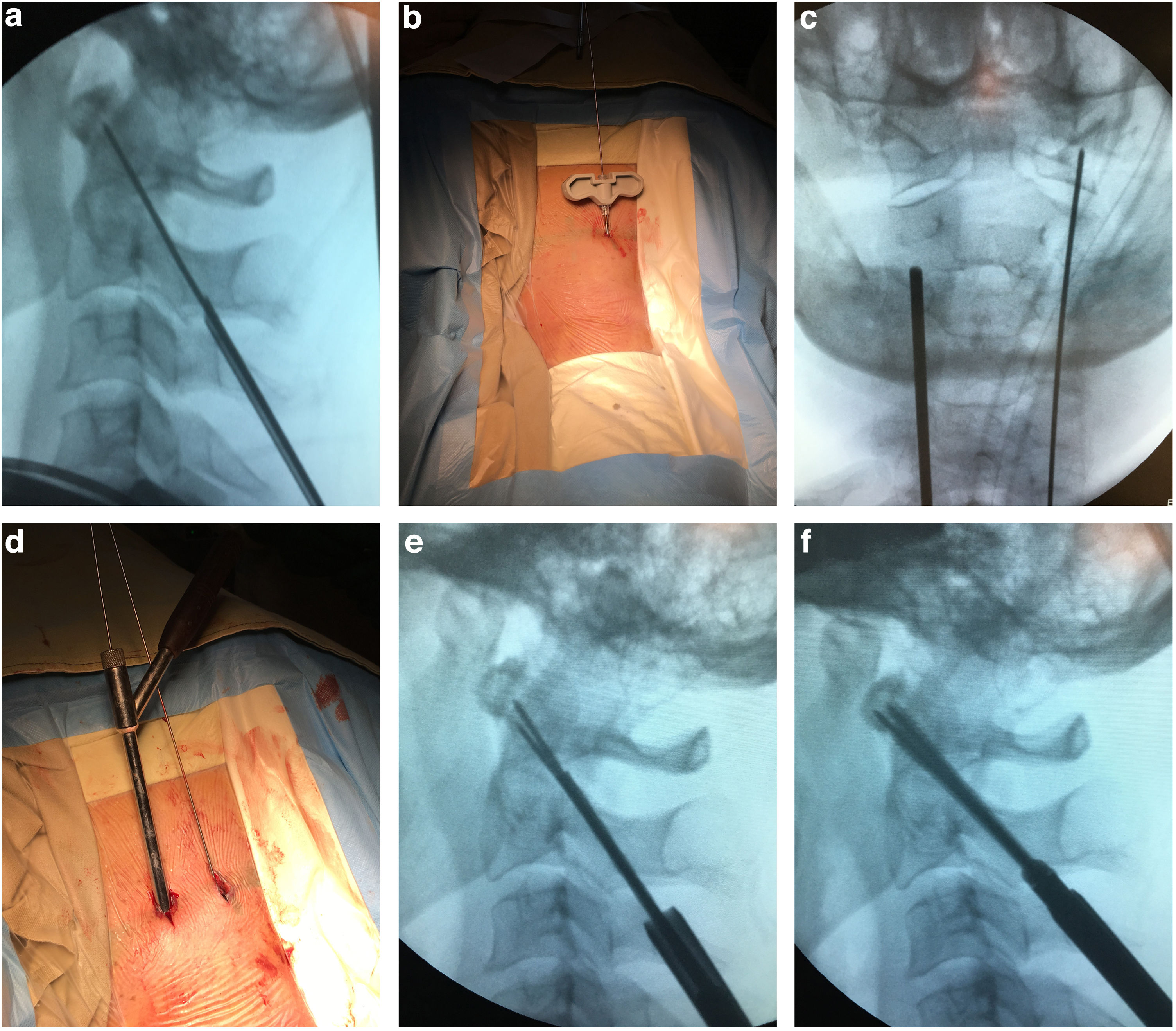 Fully percutaneous posterior transarticular C1-C2 stand-alone screw ...