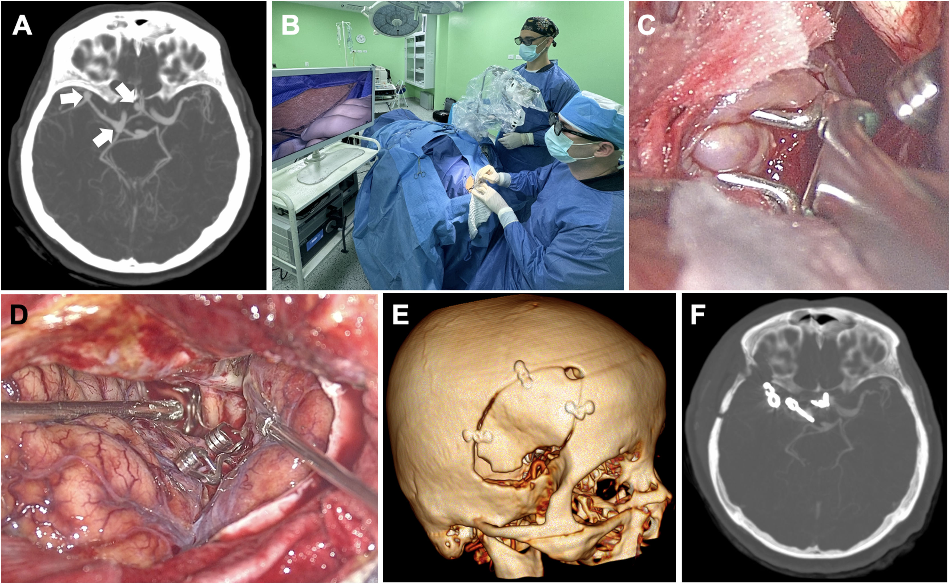 Preliminary experience with VITOM 3D exoscope during microsurgical ...