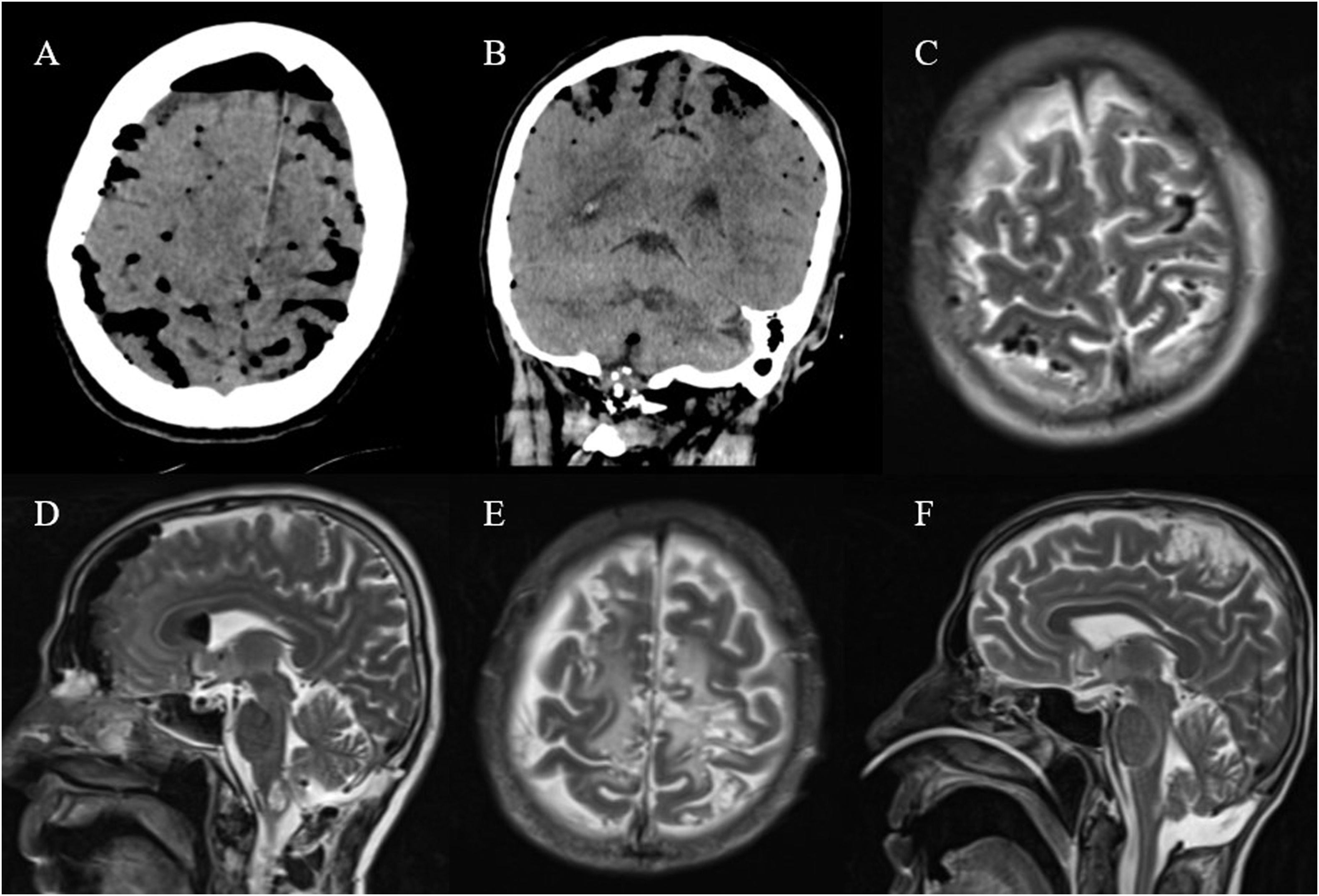 Semisitting position in neurosurgery: A 20-year experience in a ...