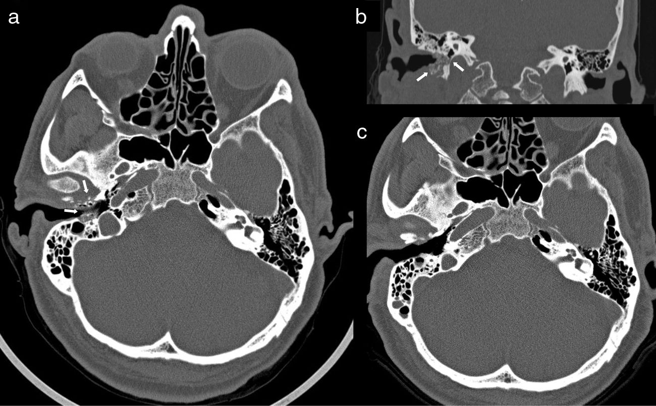 malignant otitis externa ct