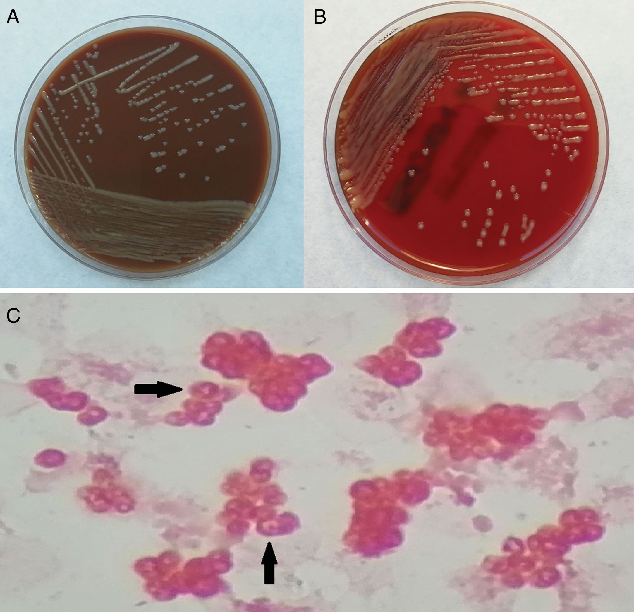 Bacteremia caused by Paracoccus yeei in patient with compensated ...