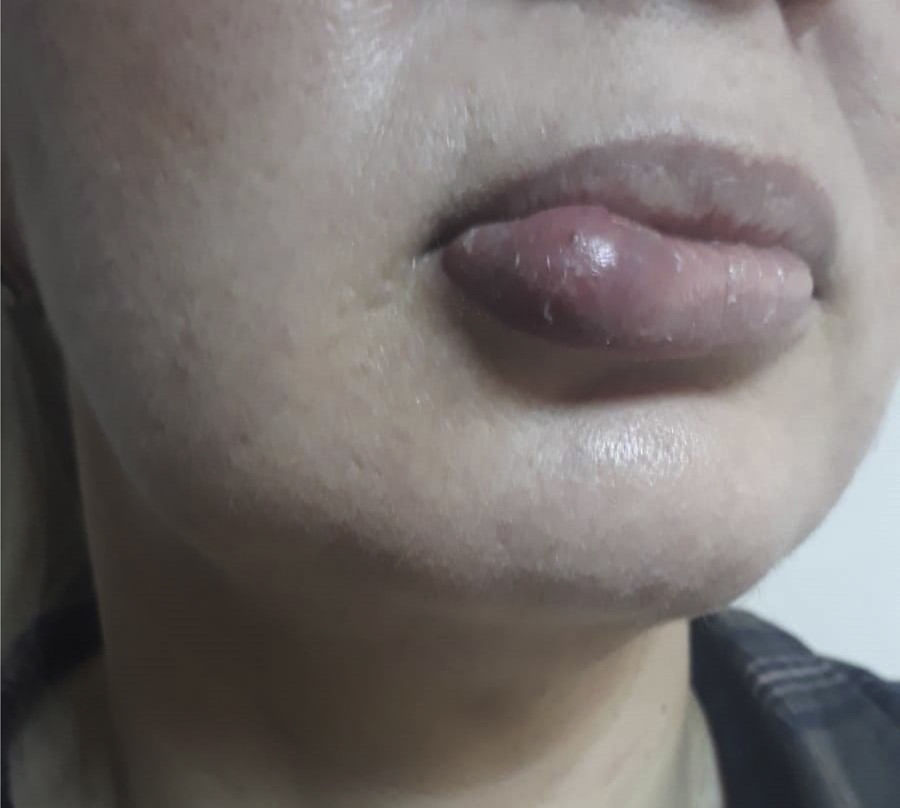 A woman with lip lesion and submandibular lymphadenopathy ...