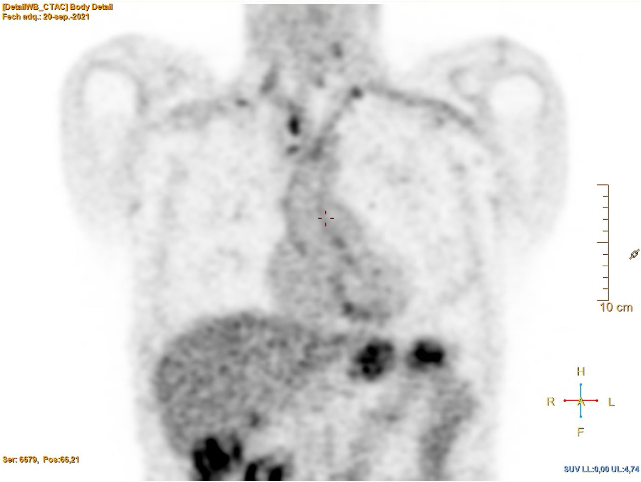 BCGitis with aortoiliac aneurysm involvement: Report of two cases and ...