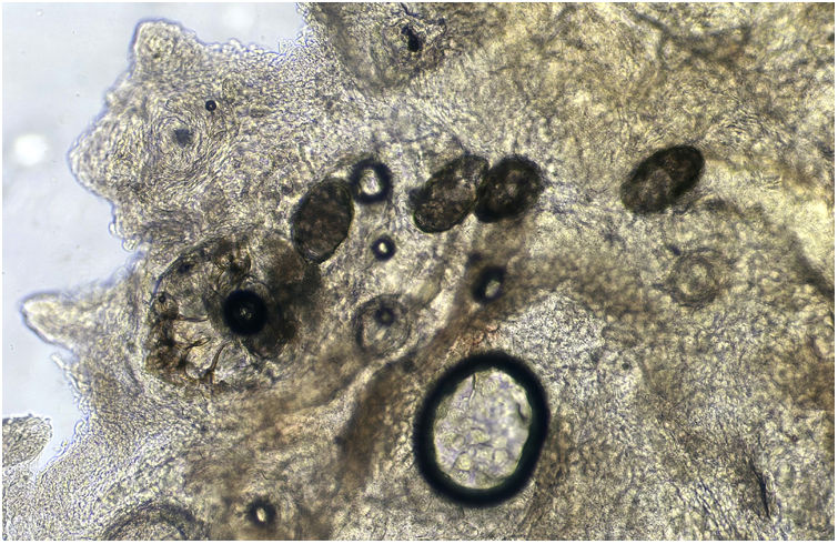 Atypical bullae in hands and trunk: An unusual suspect | Enfermedades ...