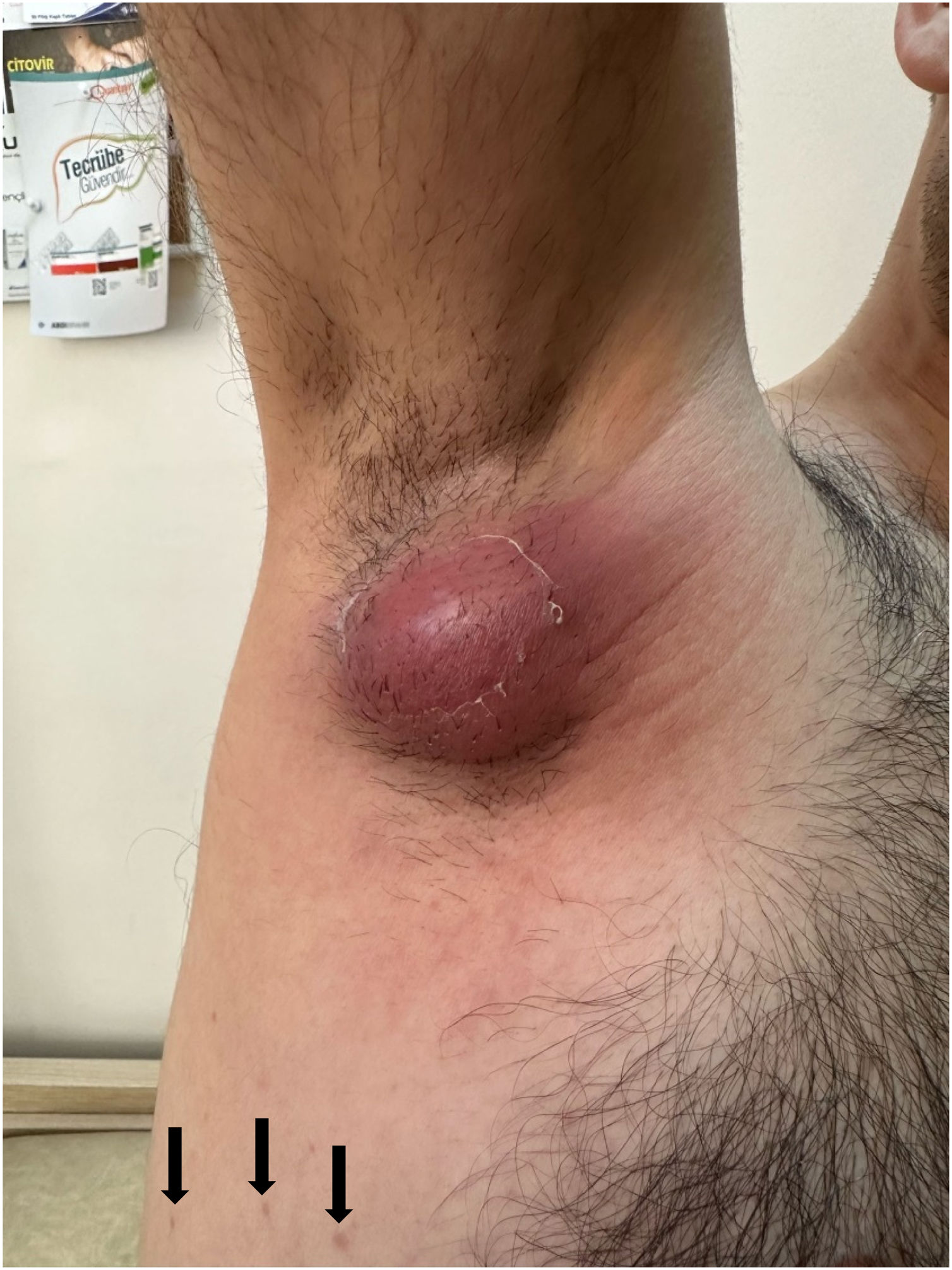 abscess armpit surgery