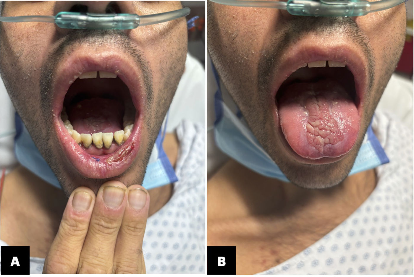 Uncommon lip lesions in an HIV individual | Enfermedades Infecciosas y ...