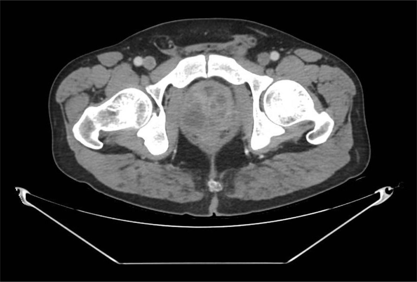 Prostatic abscesses as a cause of persistent Staphylococcus aureus ...