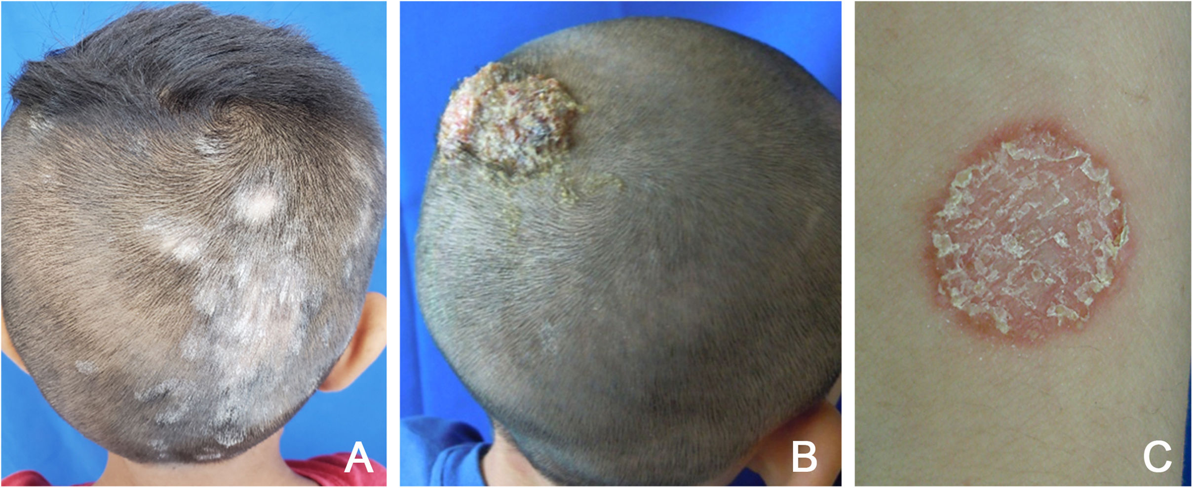 Dermatophytosis caused by Nannizzia gypsea: report of 155 cases from ...