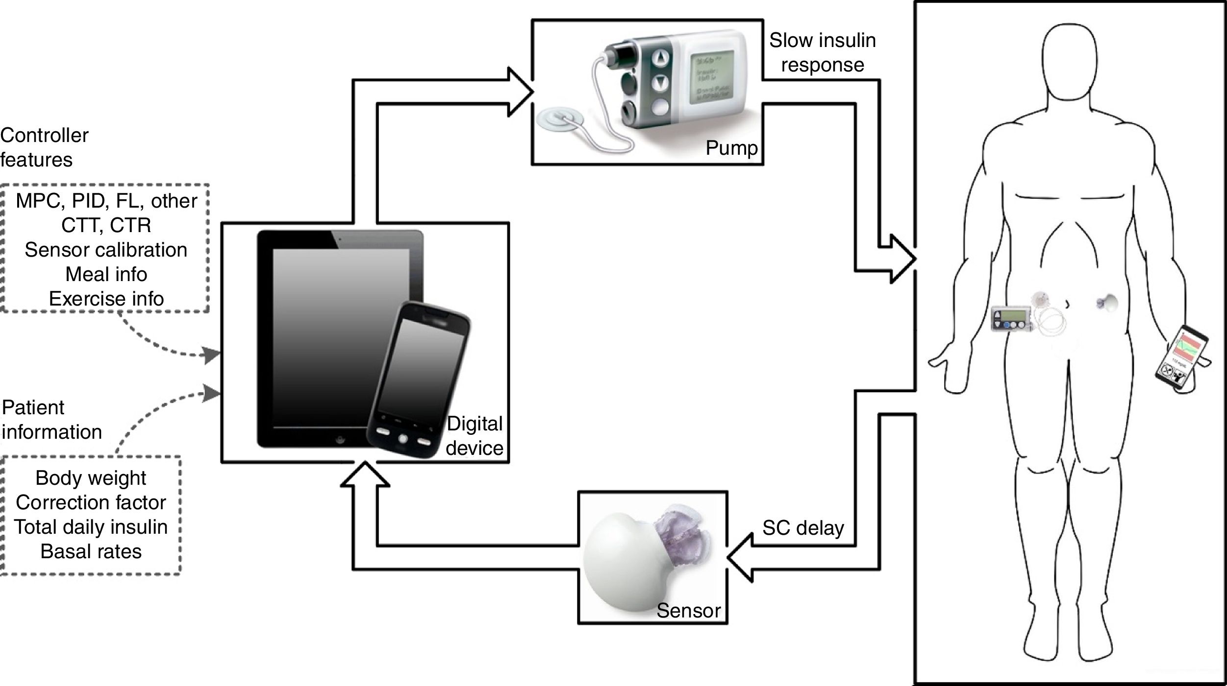 diabetes type 1 closed loop