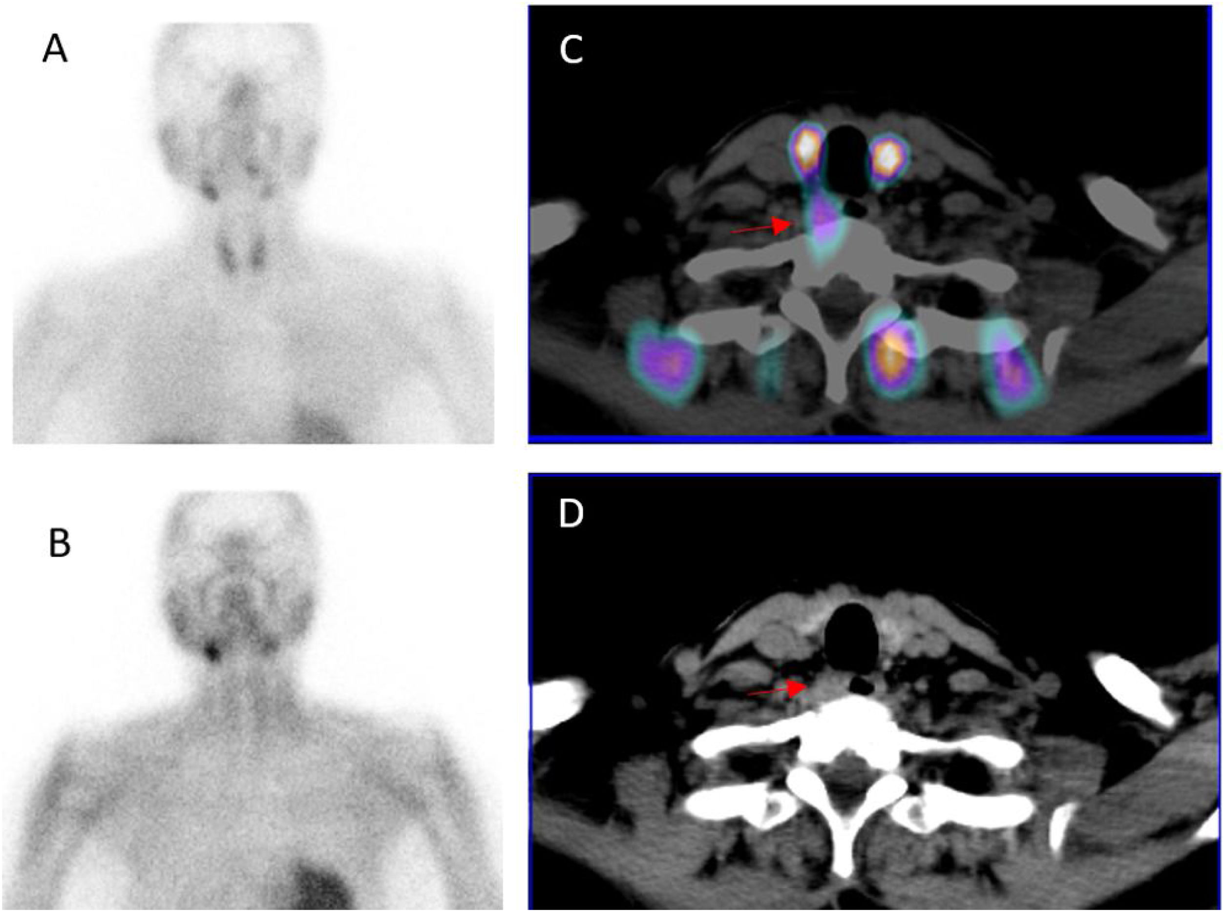 parathyroid mibi scan
