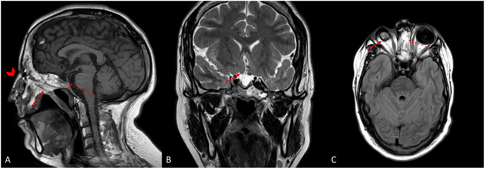 Clinical report of Bosma arhinia microphthalmia syndrome with a new ...