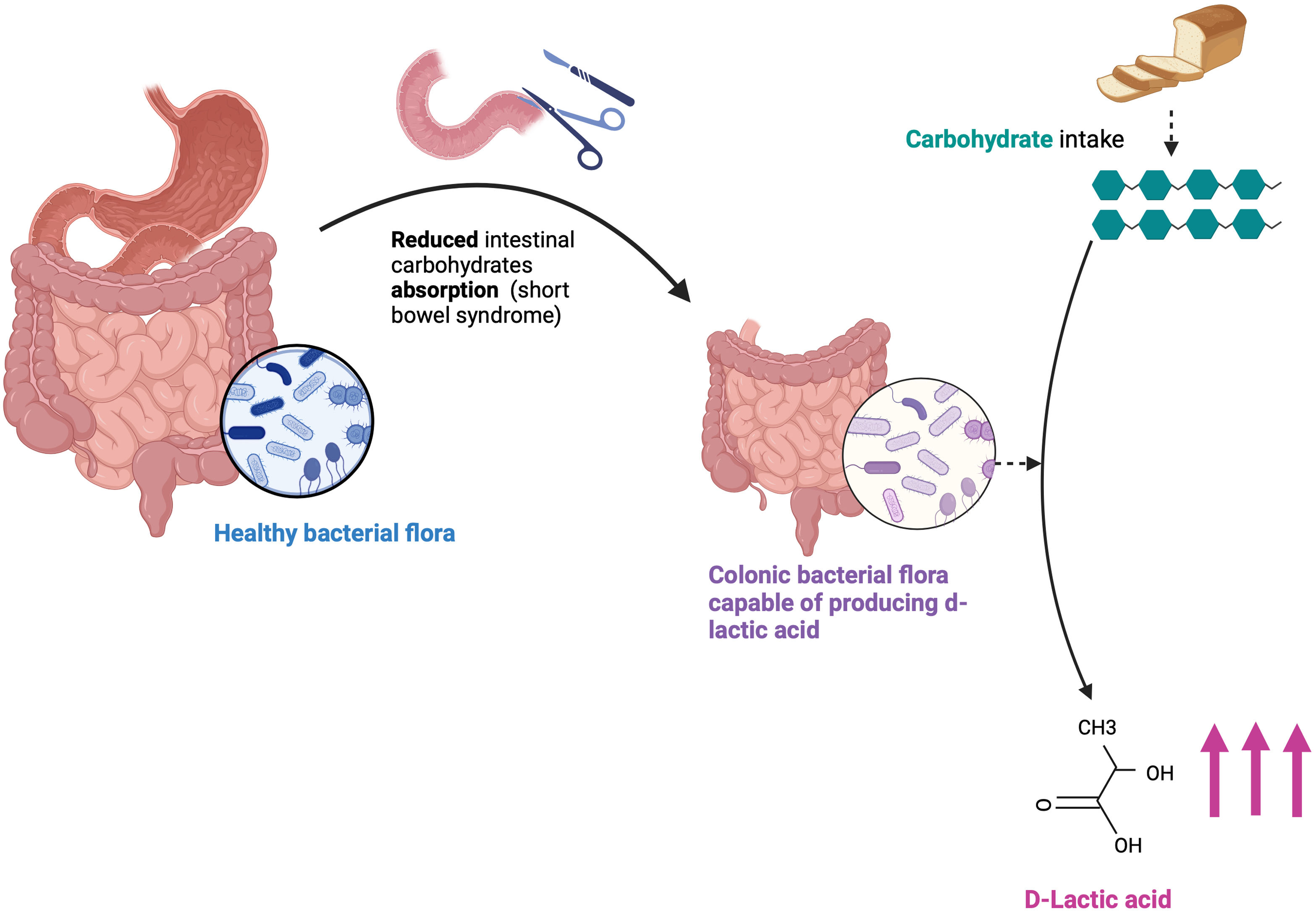 Short bowel syndrome and d-lactic acidosis: A case report with ...