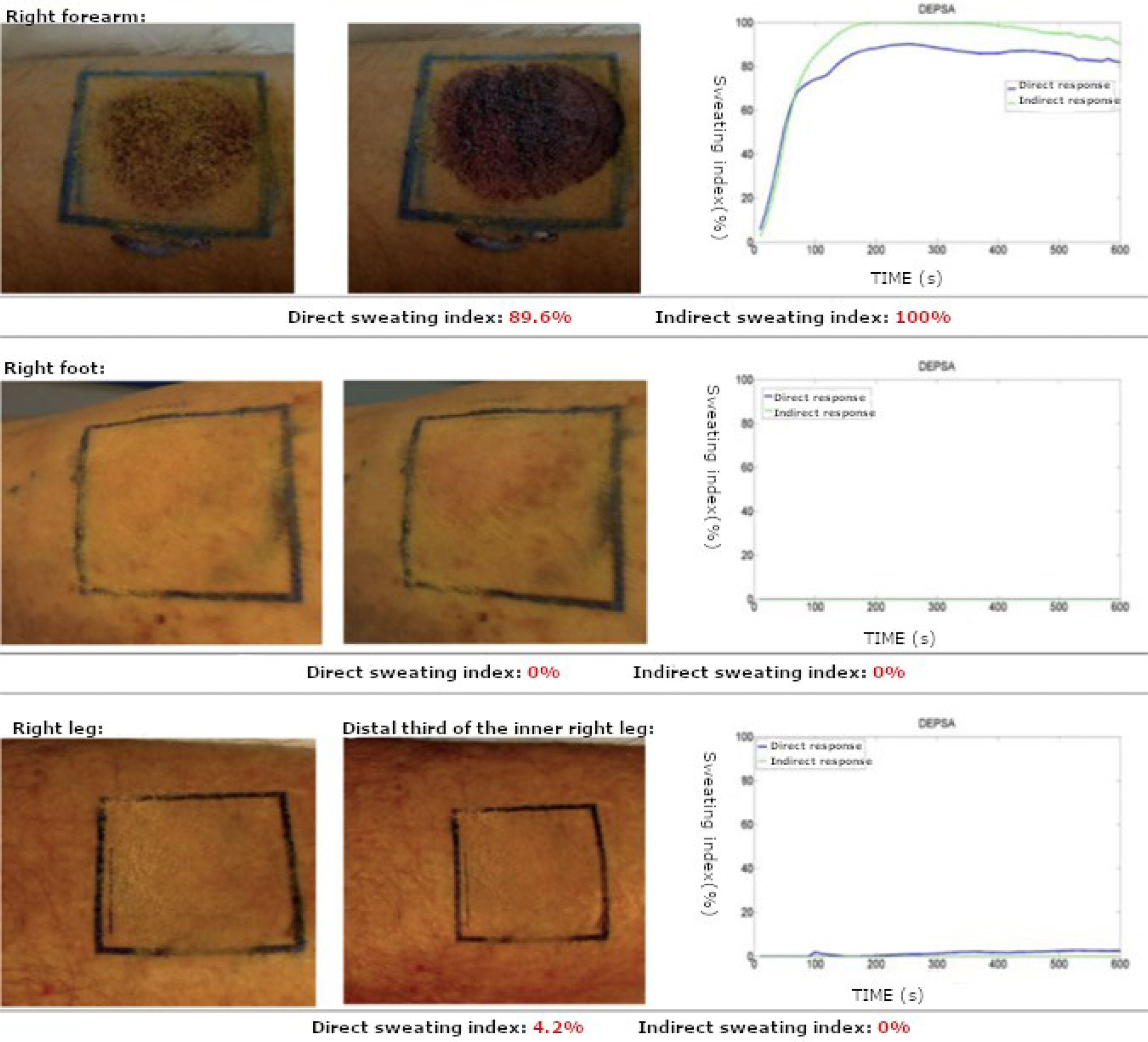 Sudomotor dysfunction in type 1 diabetes: A case report ...