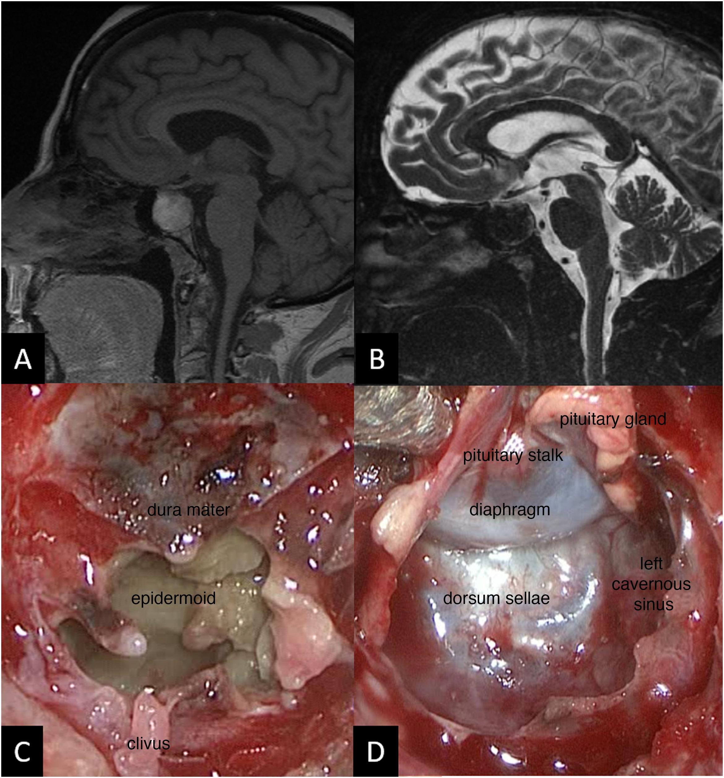 intraglandular cyst